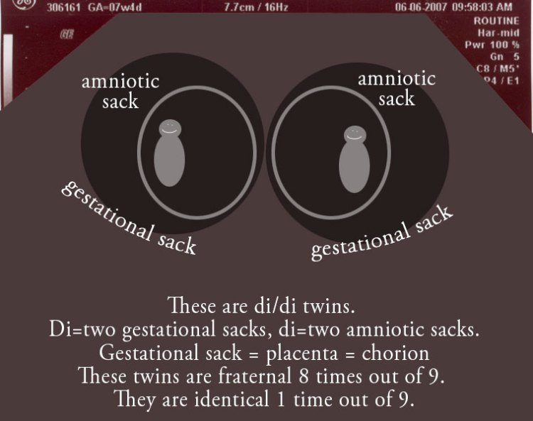 Types of twins and triplets – pyjammy dot blog