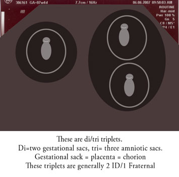 Types of twins and triplets – pyjammy dot blog